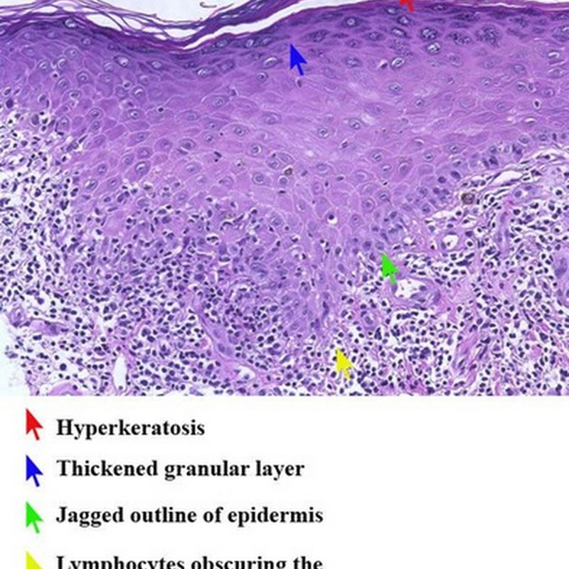Lichen Planus Histology